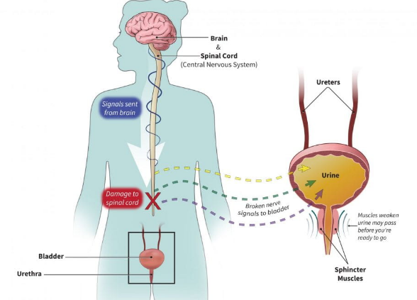 Neurogenic Bladder – Clinic Of Urology & Kidney Transplant